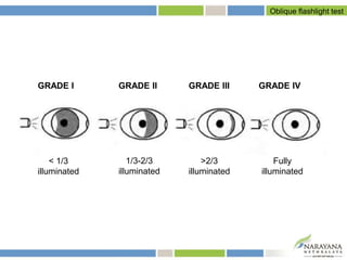 Assessment of Anterior Chamber Angle
