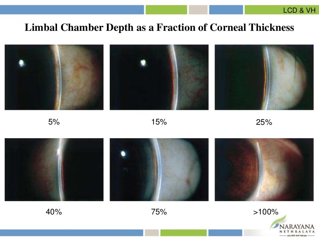 Assessment of Anterior Chamber Angle
