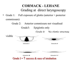 Assessment of airway | PPT