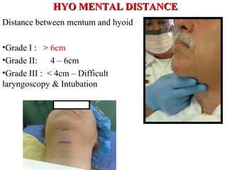 Hyomental Distance