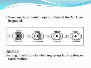 Assessment of anterior chamber | PPTX