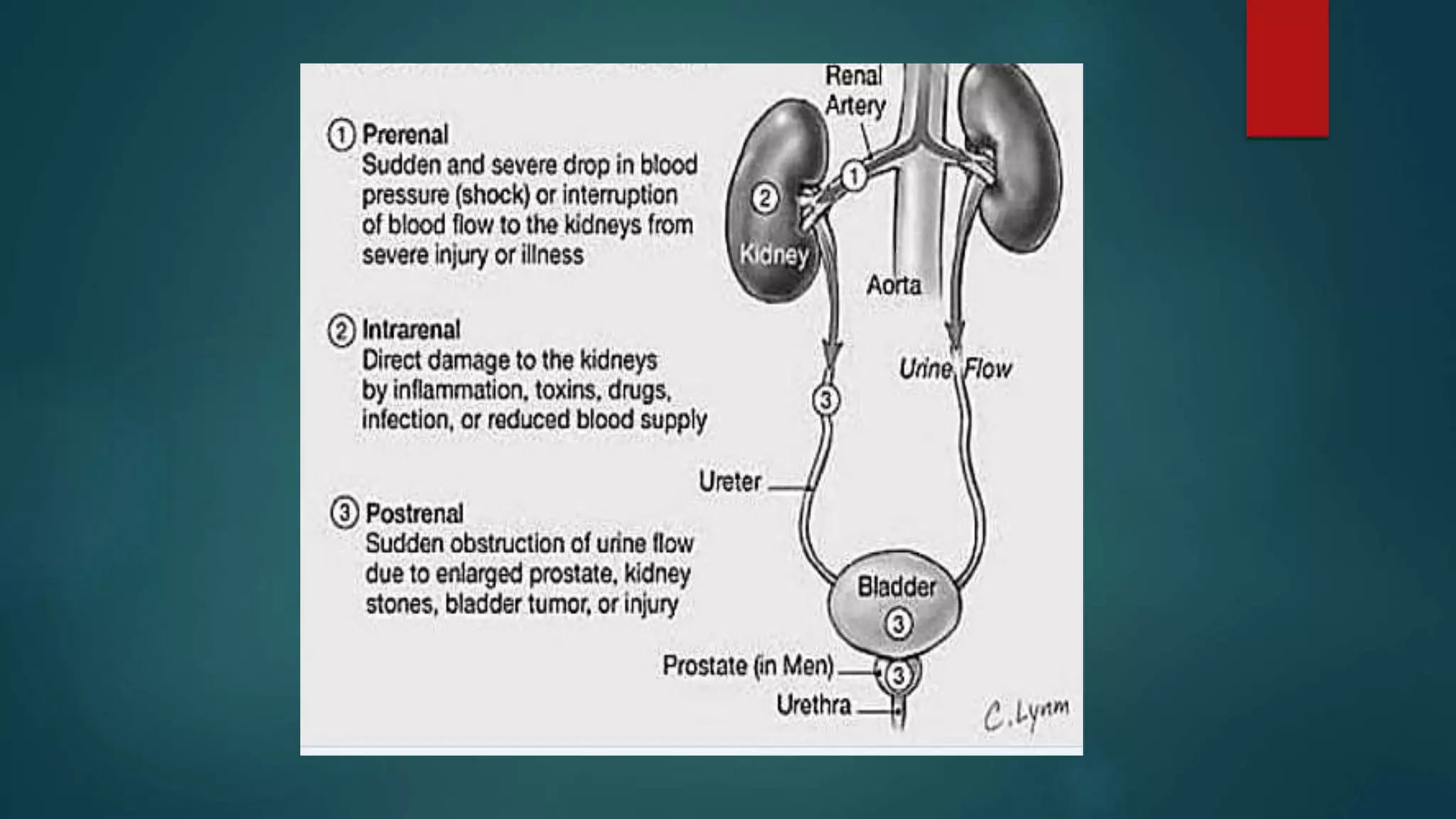 Assessment of anuria & management of post obstructive diuresis | PPT