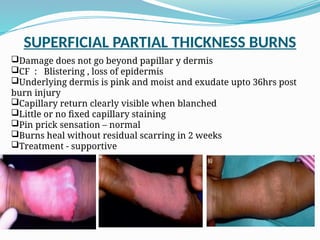ASSESSMENT OF BURN WOUND.pptx surgery | PPTX
