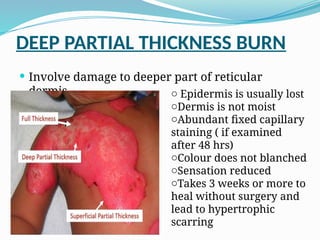 ASSESSMENT OF BURN WOUND.pptx surgery | PPTX
