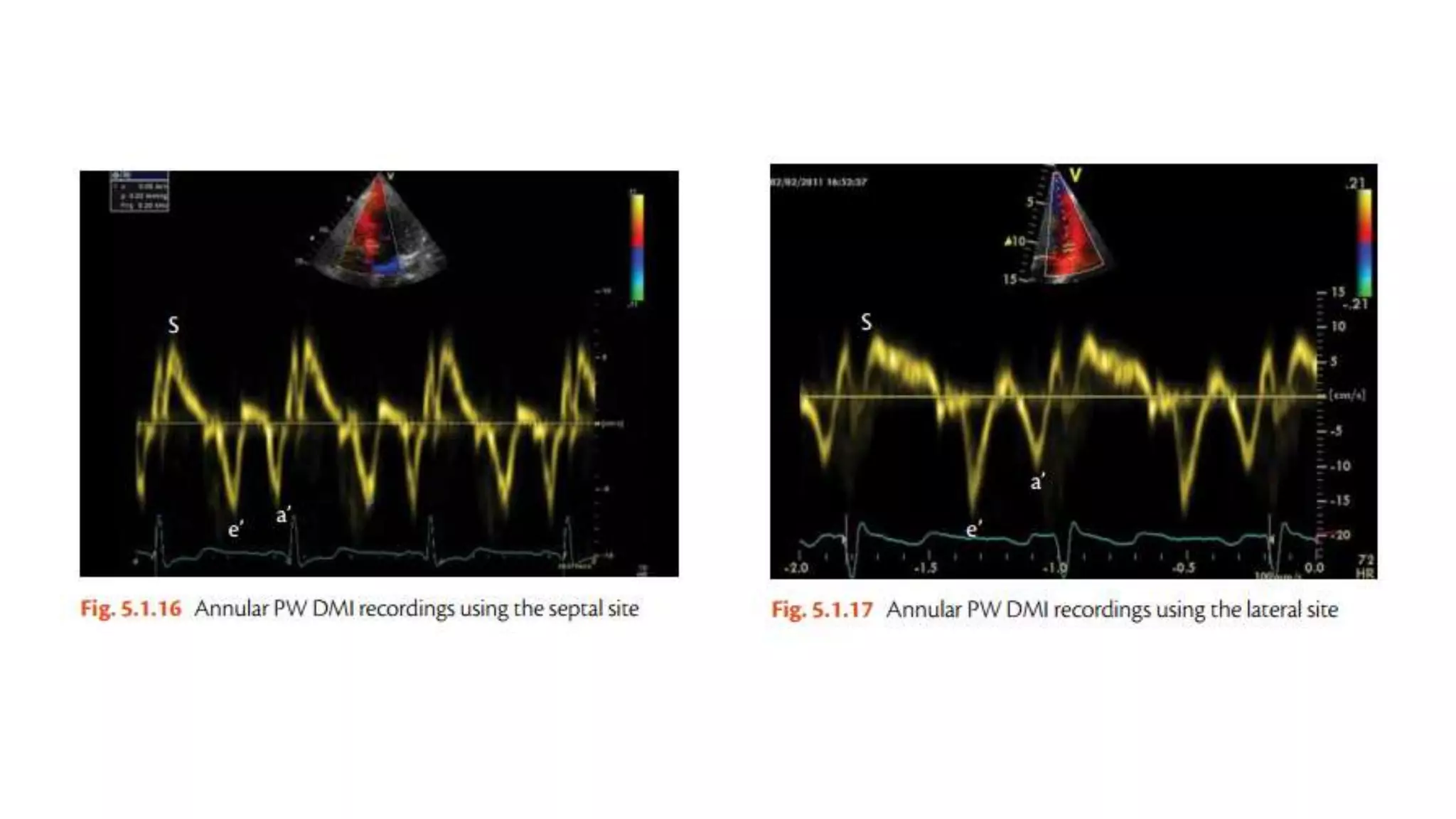 Assessment of diastolic function by echo | PPTX