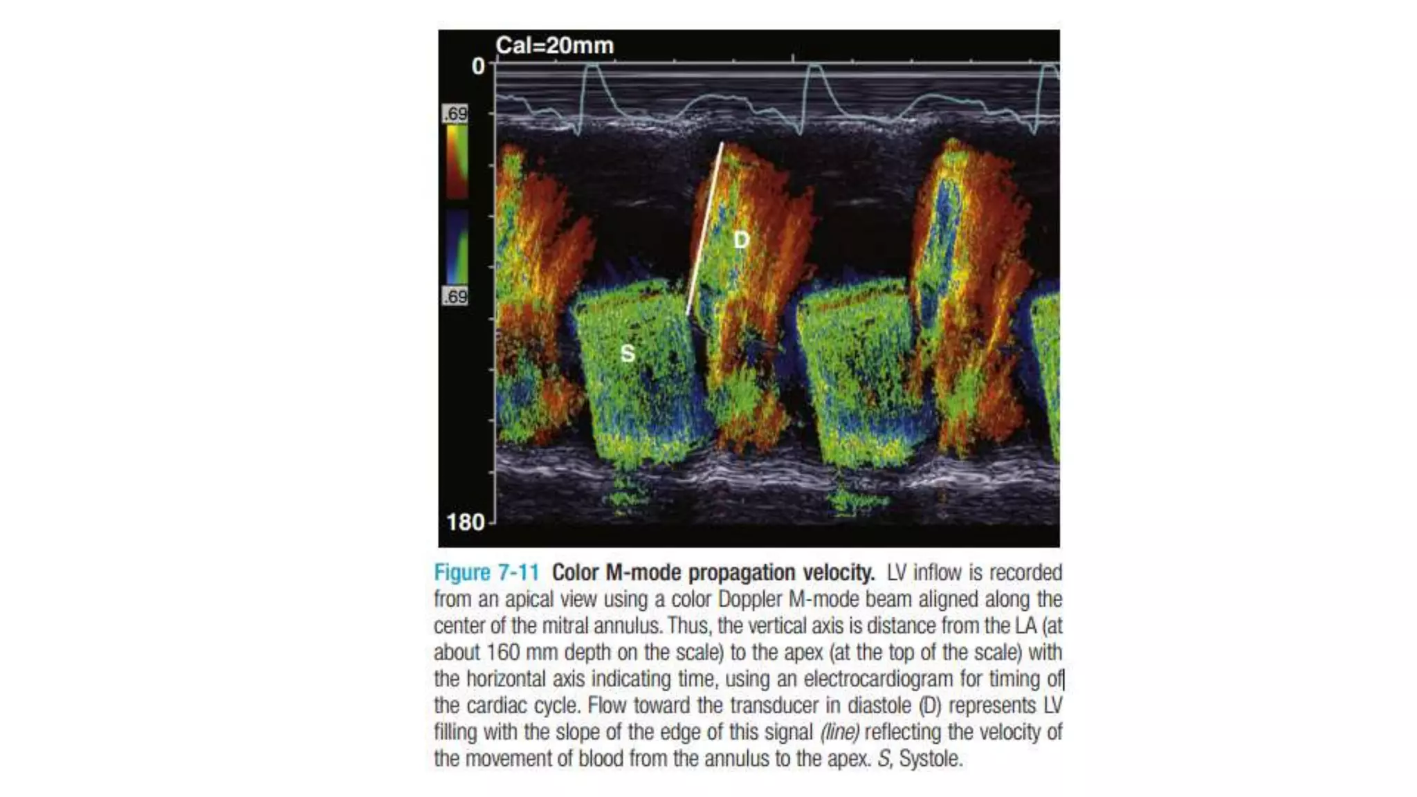 Assessment of diastolic function by echo | PPTX