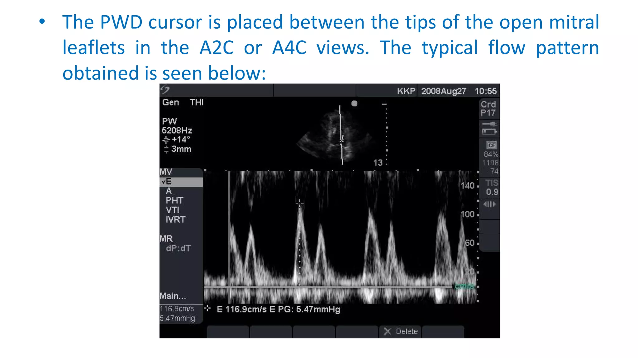 Assessment of diastolic function by echo | PPTX