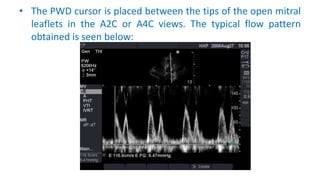 Assessment of diastolic function by echo | PPTX