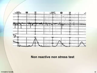 Reactive Non Stress Test
