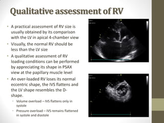 Assessment of Global RV systolic function_ECHO 7.pdf