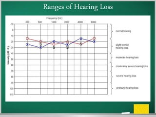 Assessment of hearing | PPTX