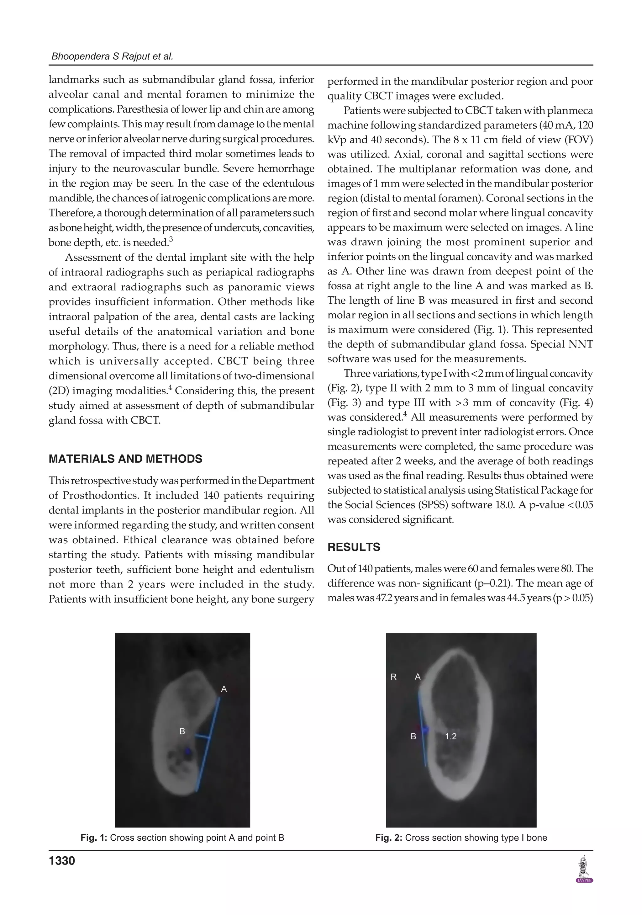 Assessment of Lingual Concavities in Submandibular Fossa Region in ...