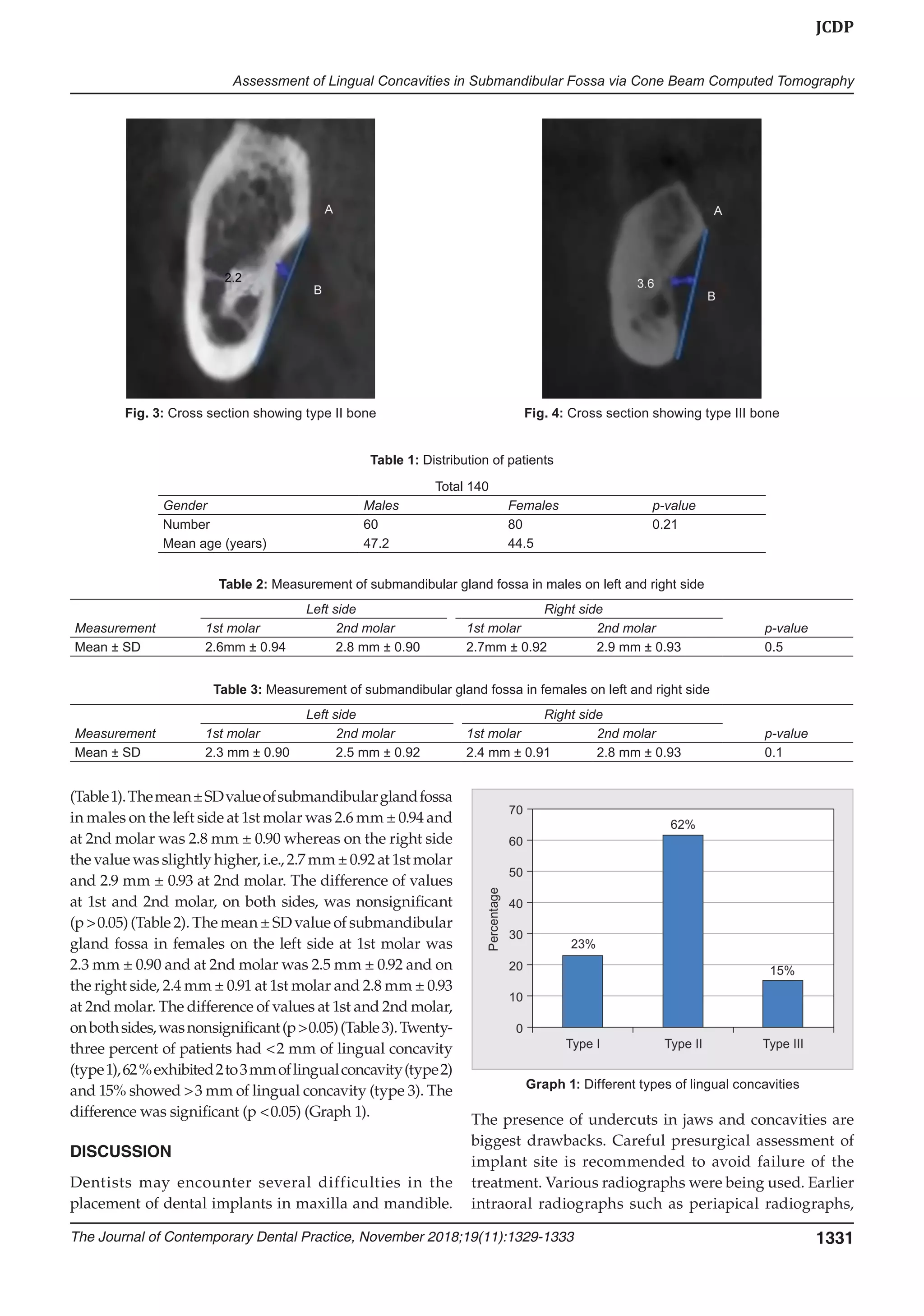 Assessment of Lingual Concavities in Submandibular Fossa Region in ...