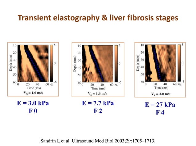 Assessment of liver fibrosis by us elastography | PPTX