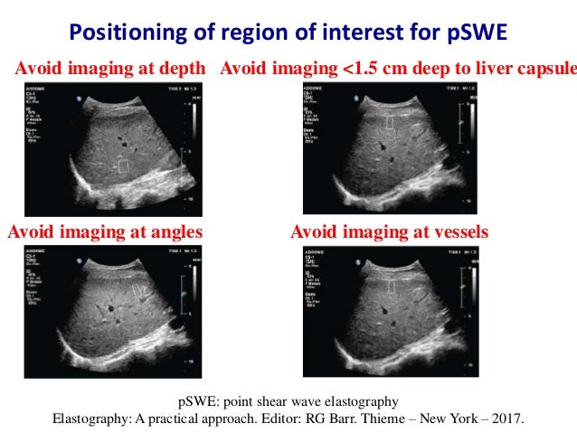 Assessment of liver fibrosis by us elastography