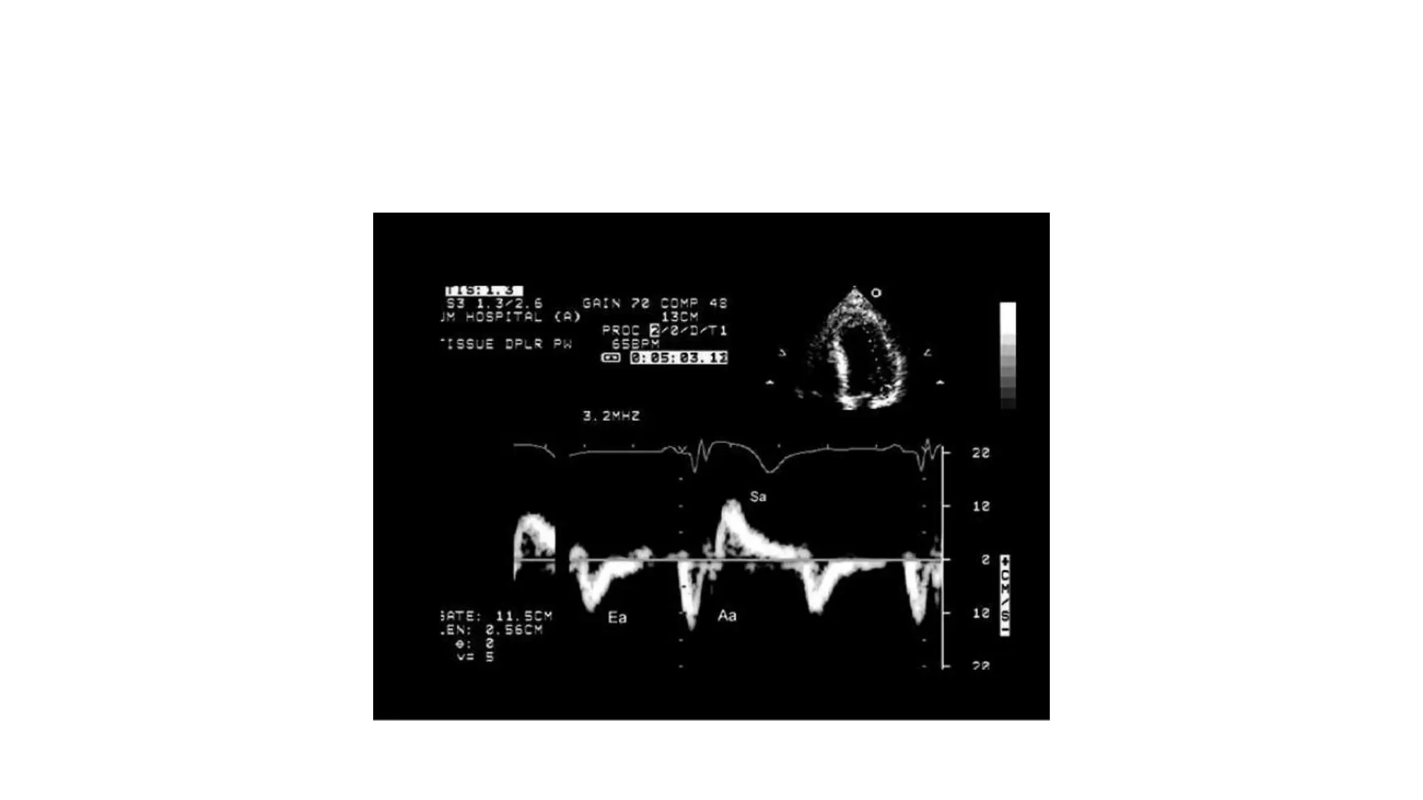 assessment of lv systolic function by echocardiographypptx | PPTX