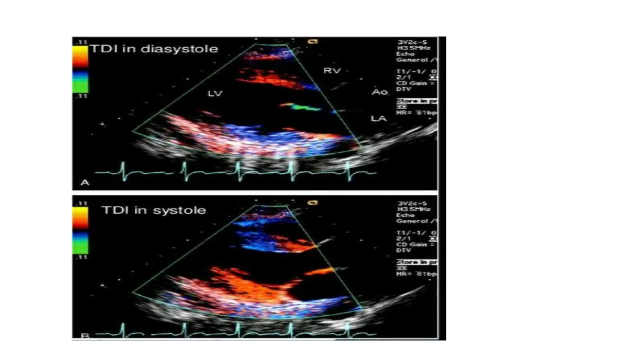 assessment of lv systolic function by echocardiographypptx | PPTX