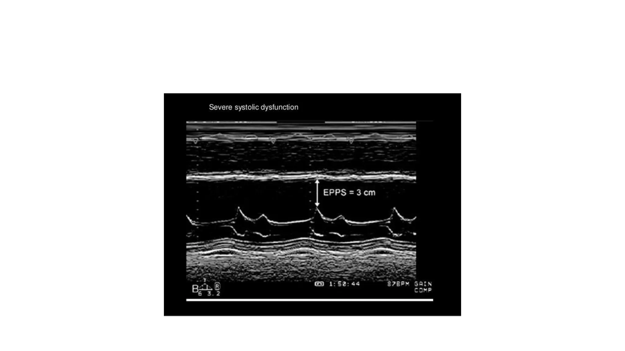 assessment of lv systolic function by echocardiographypptx | PPTX