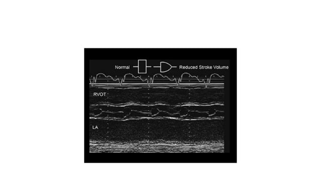 assessment of lv systolic function by echocardiographypptx | PPT