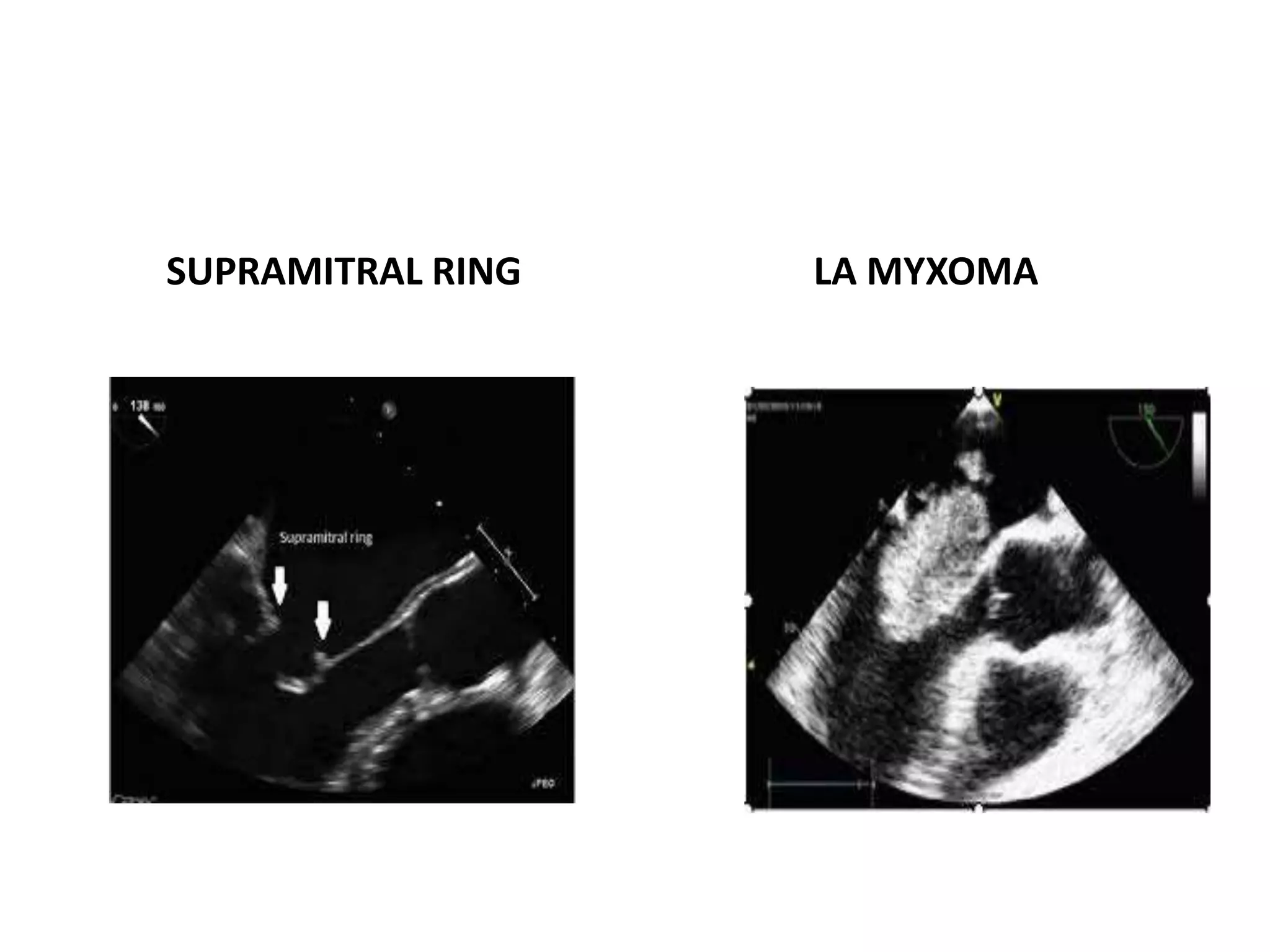 Assessment of mitral valve by TEE | PPTX