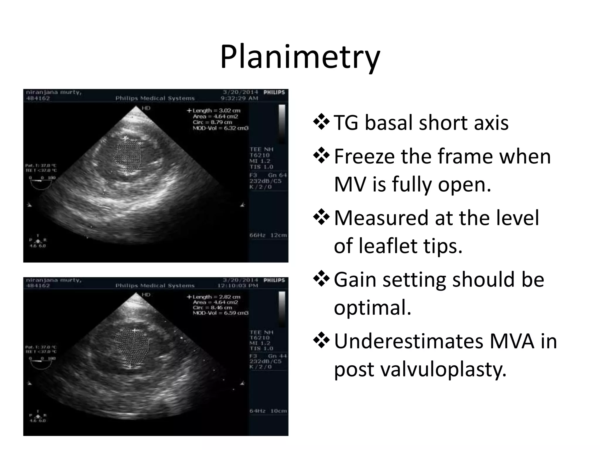 Assessment of mitral valve by TEE | PPTX