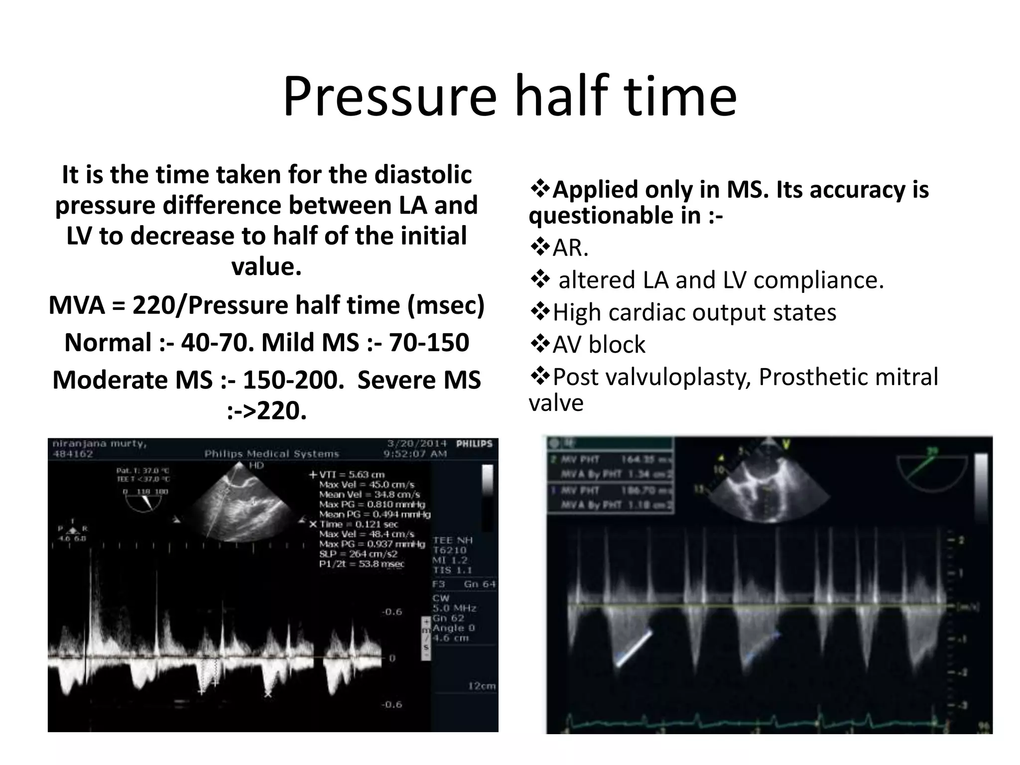 Assessment of mitral valve by TEE | PPTX