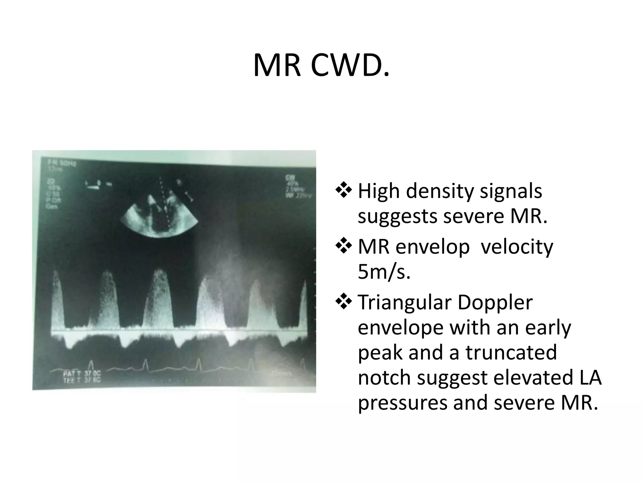 Assessment of mitral valve by TEE | PPTX