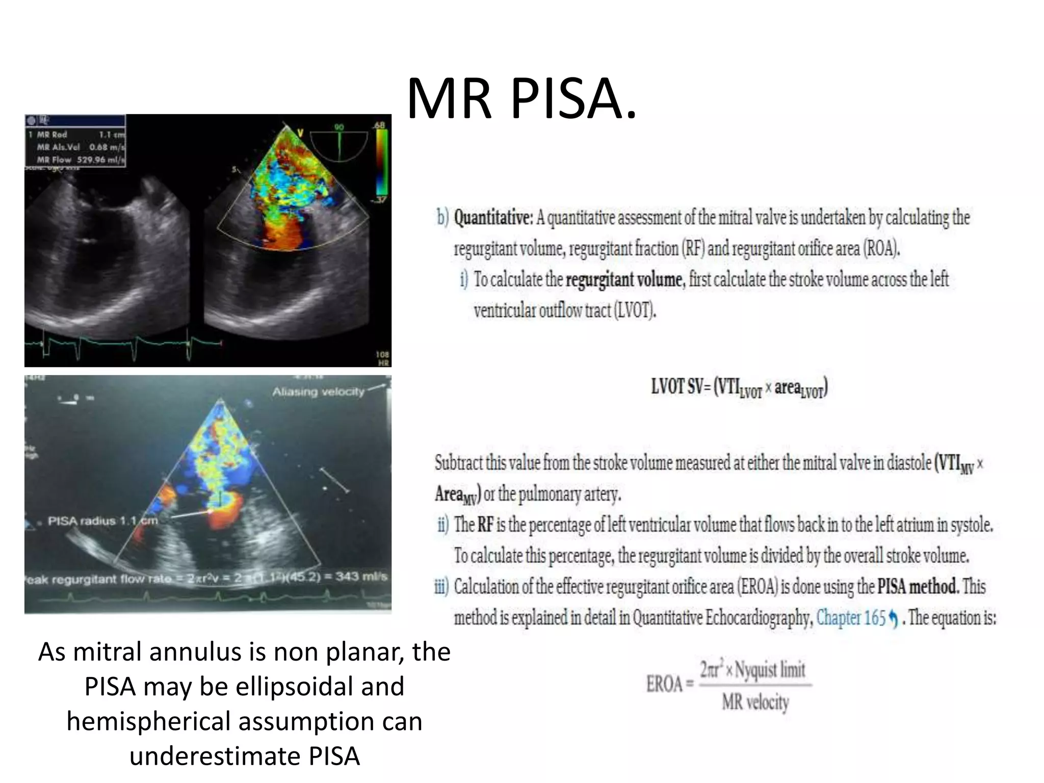 Assessment of mitral valve by TEE | PPTX