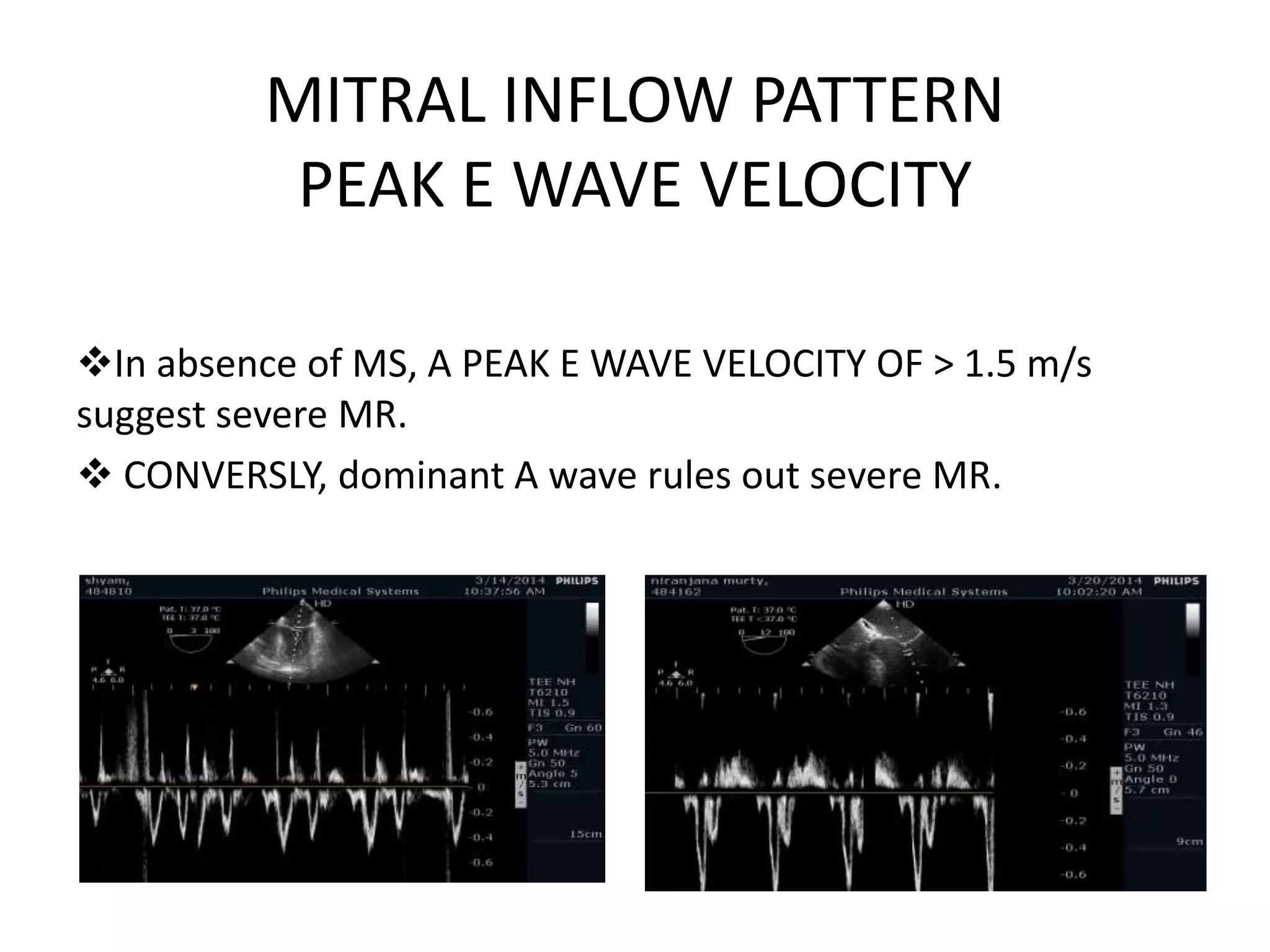 Assessment of mitral valve by TEE | PPTX