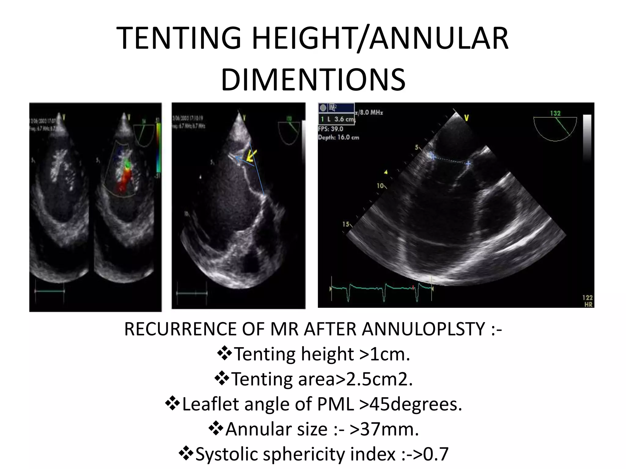 Assessment of mitral valve by TEE | PPTX