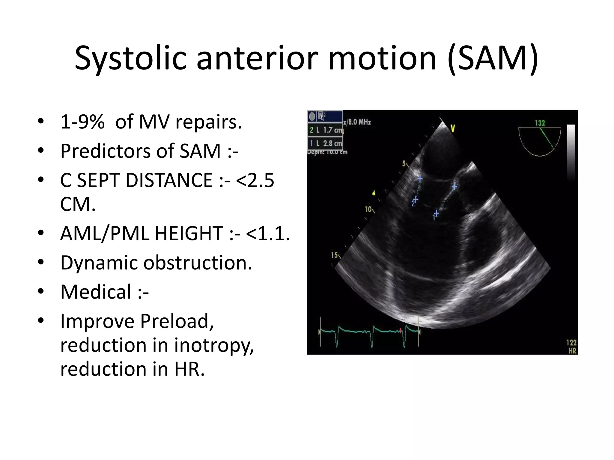 Assessment of mitral valve by TEE | PPTX