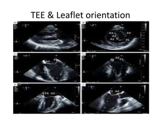 Assessment of mitral valve by TEE | PPTX