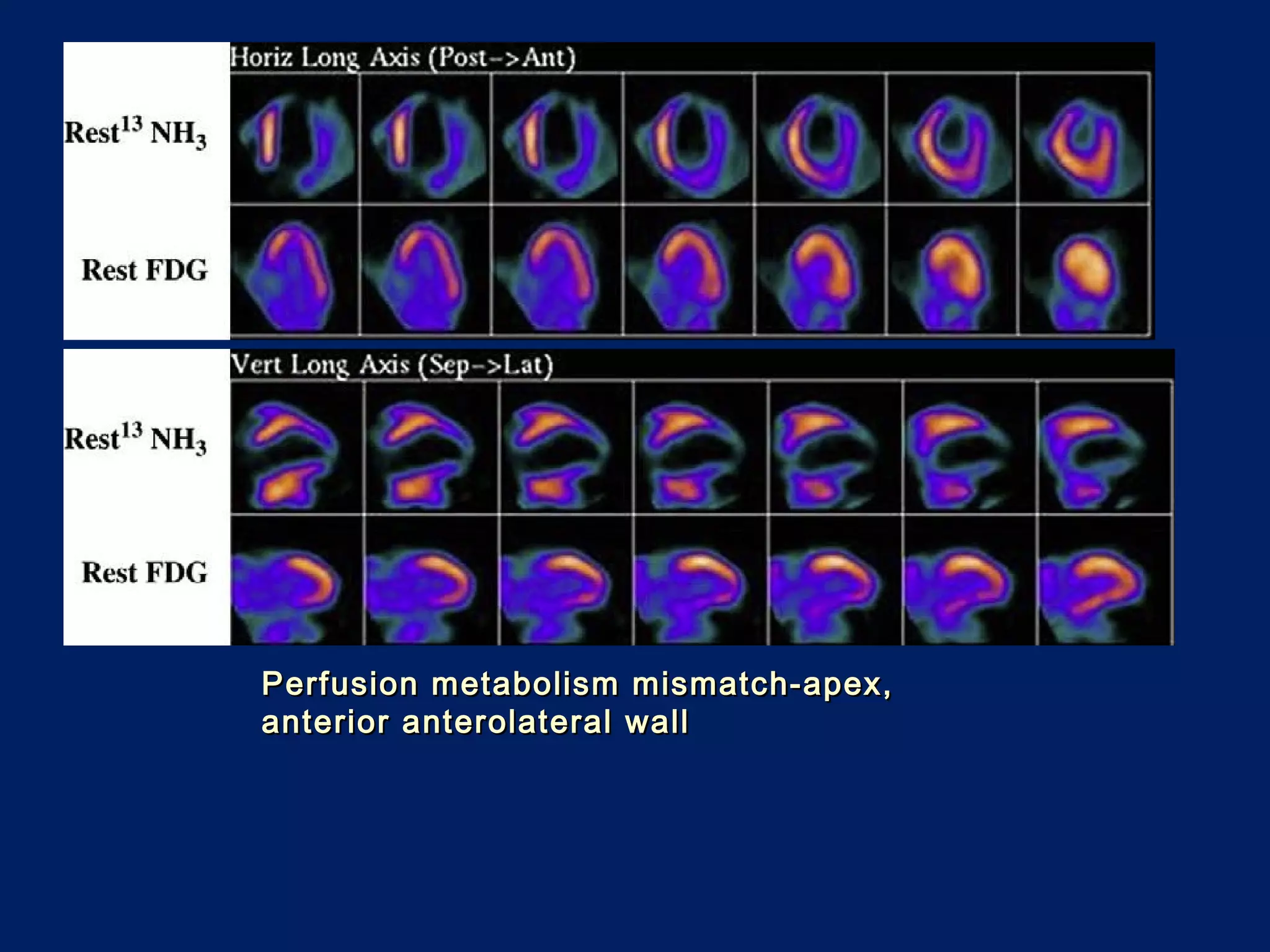 Assessment of myocardial viability | PPT