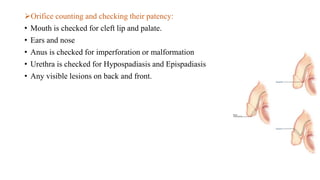 ASSESSMENT OF NEWBORN including ballard score | PPTX