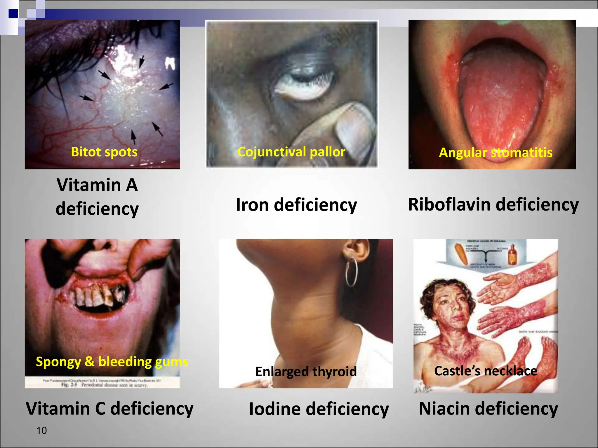 ASSESSMENT OF NUTRITIONAL STATUS - UG.ppt | Blood Disorders | Diseases and Conditions