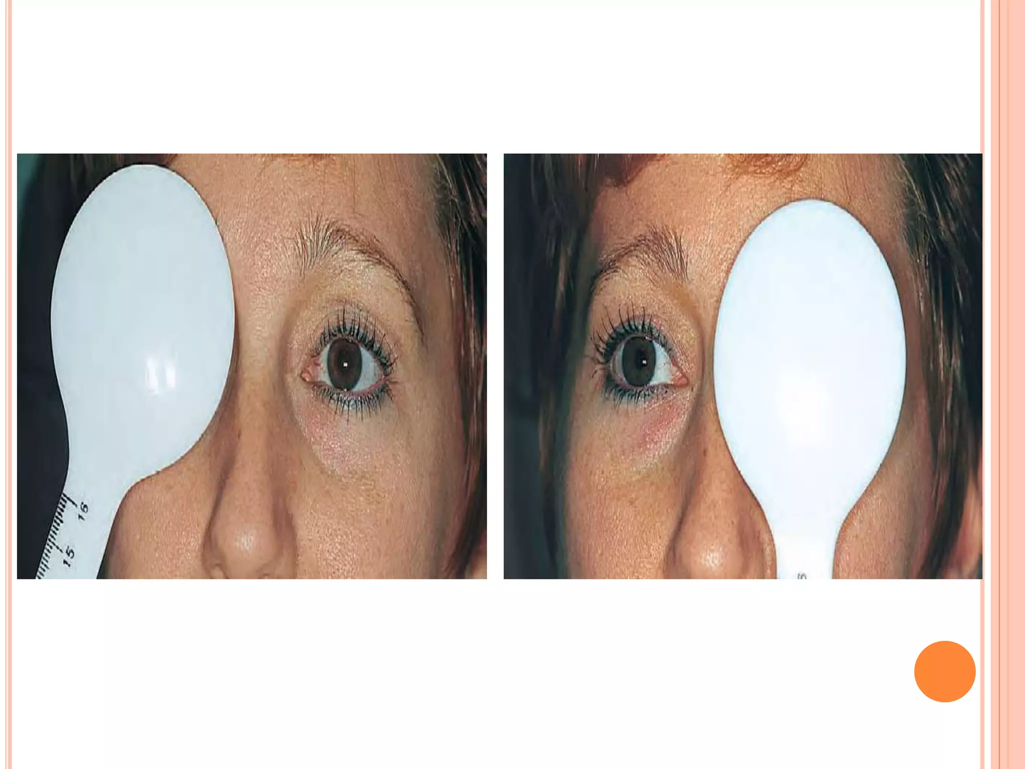 Assessment of ocular alignment | PPTX