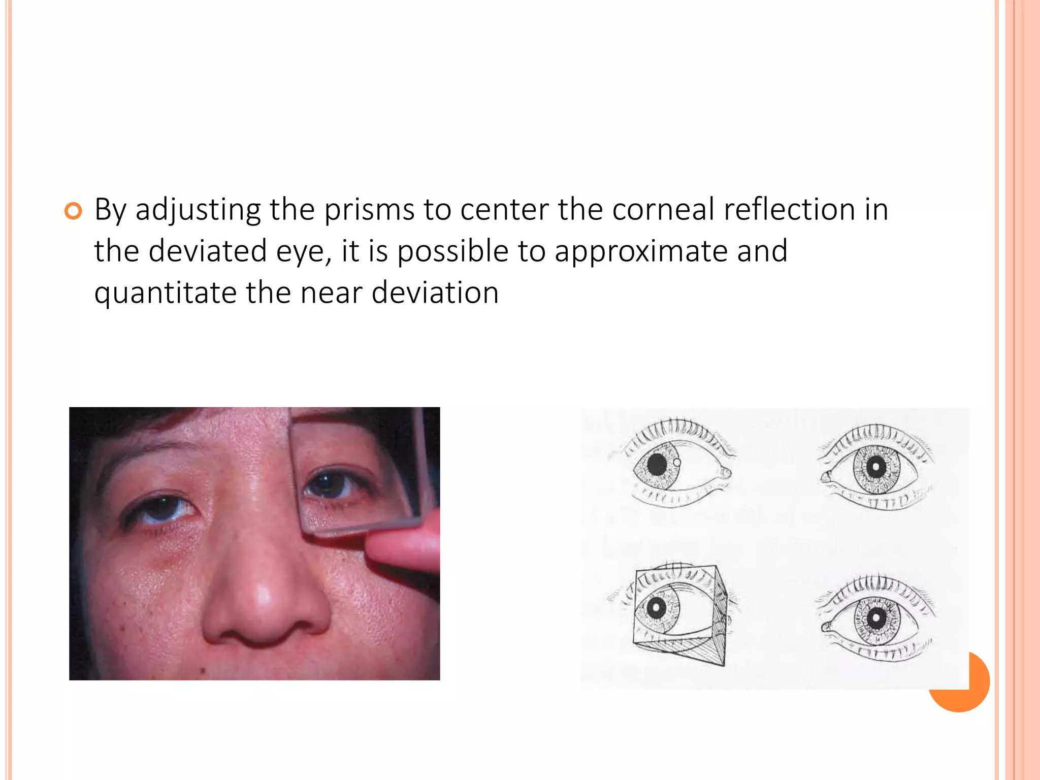 Assessment of ocular alignment | PPTX