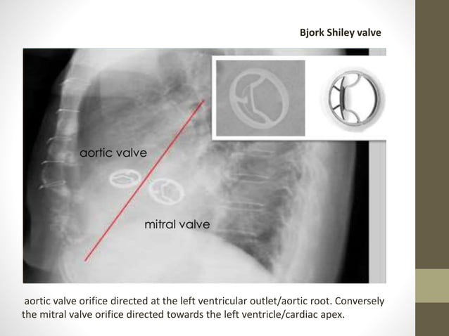 Assessment of prosthetic valve function | PPTX