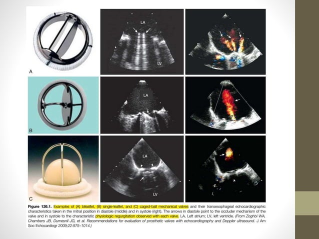 Assessment of prosthetic valve function | PPTX