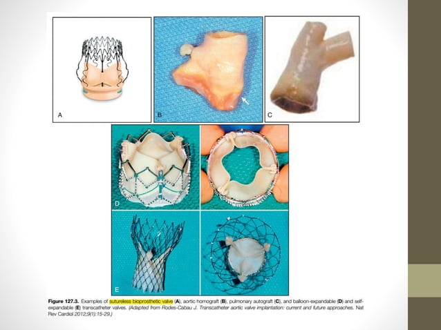 Assessment of prosthetic valve function | PPTX