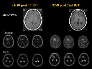 Assessment Of Recurrent Brain Tumor | PPT