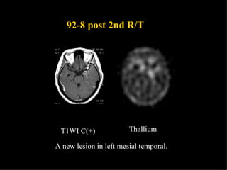 Assessment Of Recurrent Brain Tumor | PPT