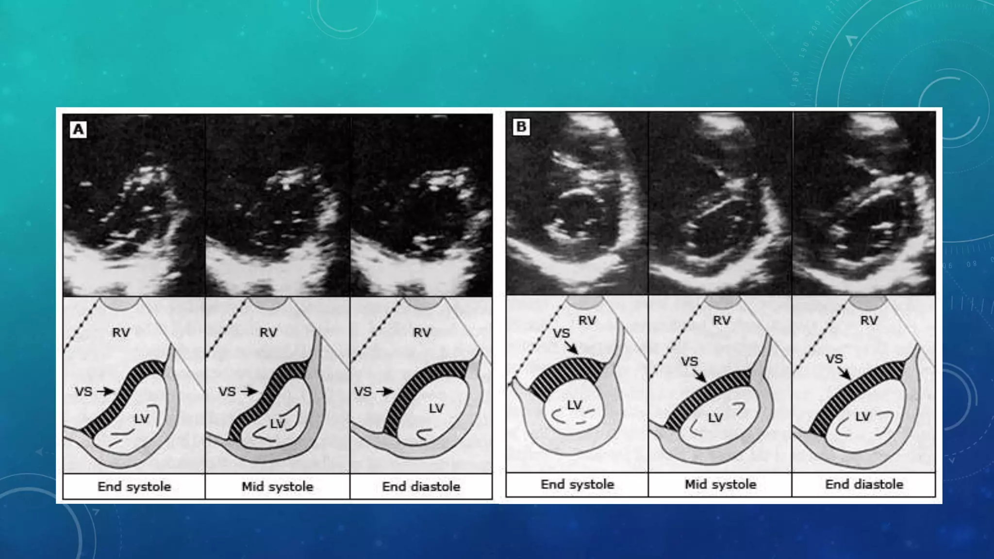 Assessment of rv function | PPTX