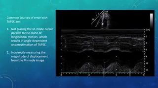 Assessment of rv function | PPTX