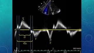 Assessment of rv function | PPTX