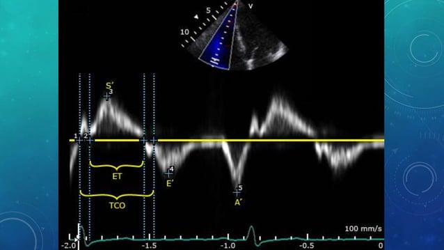 Assessment of rv function | PPTX | Heart and Cardiovascular Diseases ...