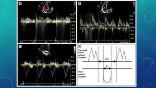 Assessment of rv function | PPTX