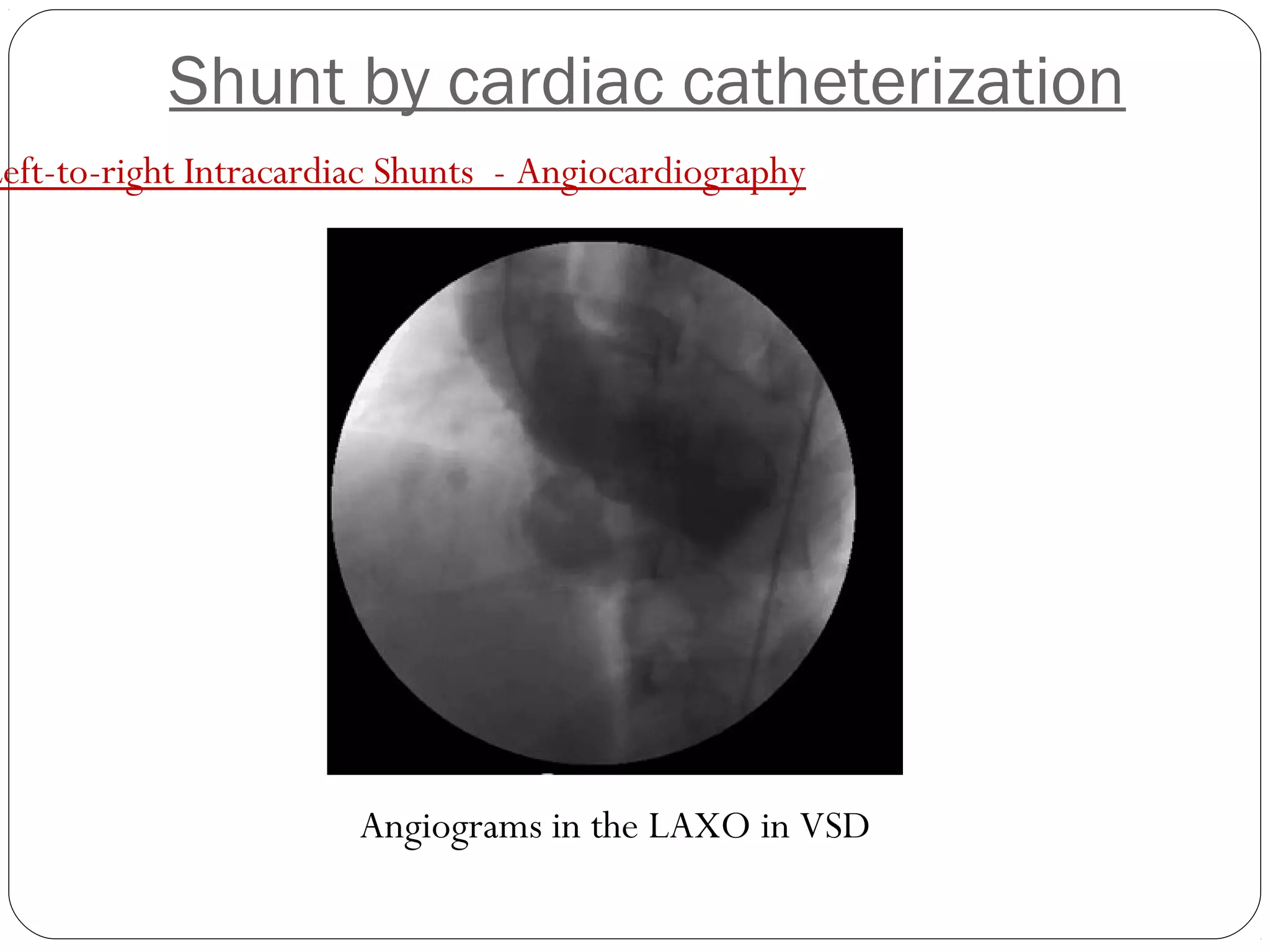 Assessment of shunt by cardiac catheterization | PPT