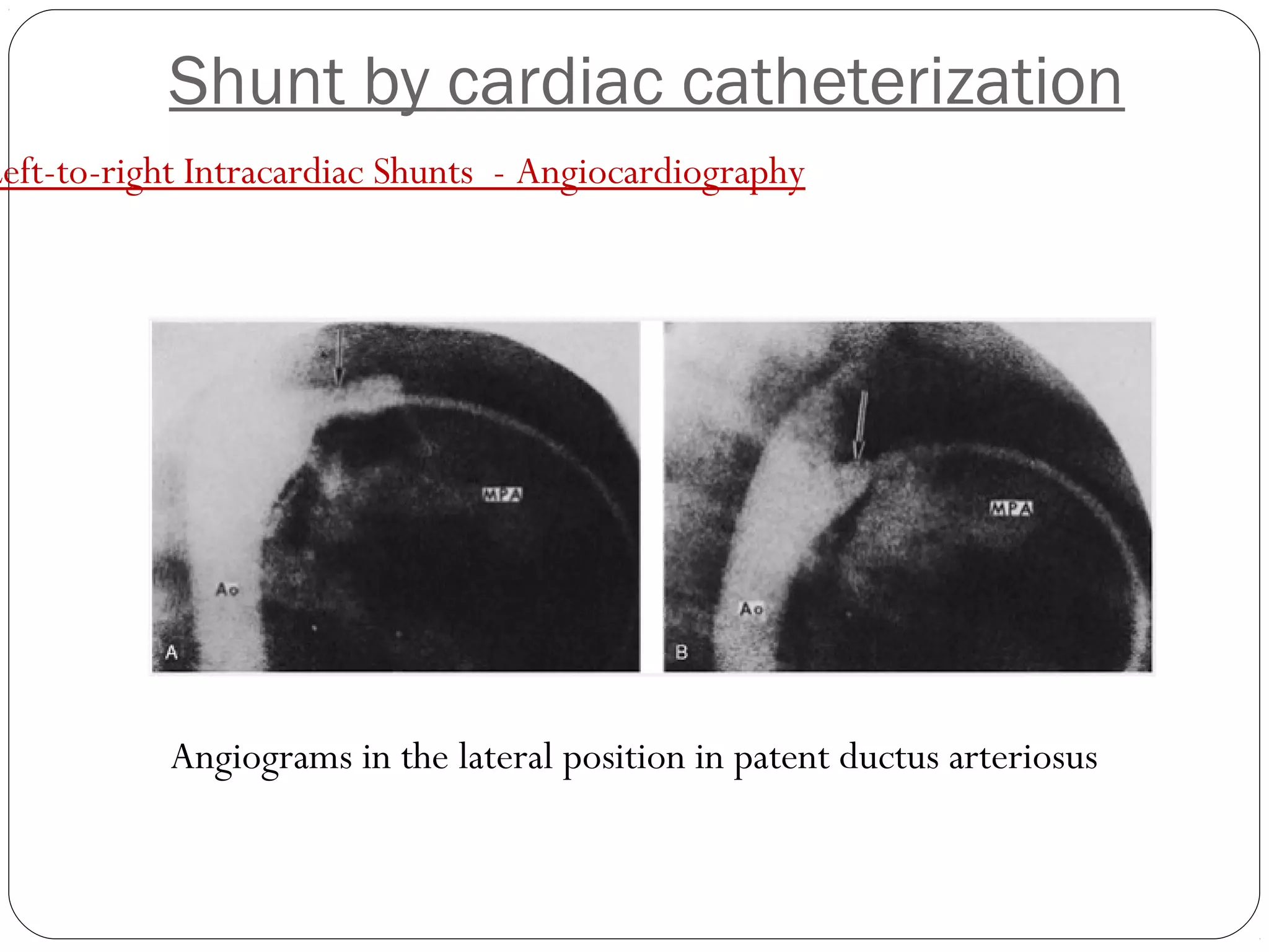 Assessment of shunt by cardiac catheterization | PPT