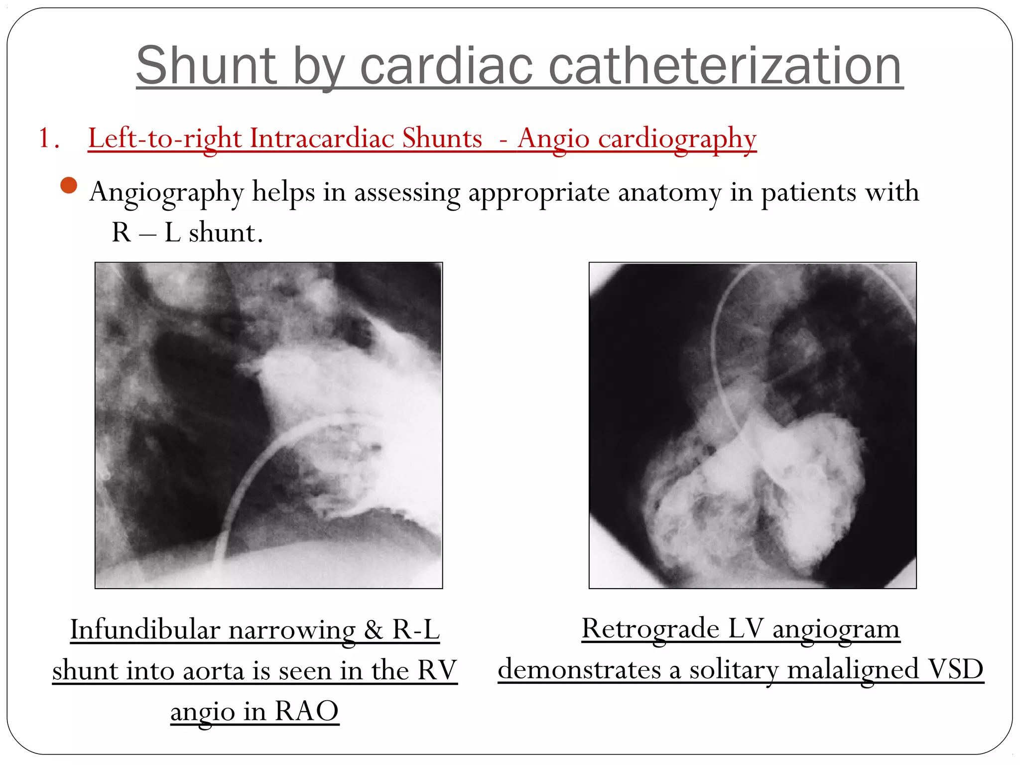 Assessment of shunt by cardiac catheterization | PPT